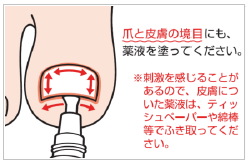 爪水虫（爪白癬）の塗り薬クレナフィン 効果、副作用、使い方、飲み薬との併用